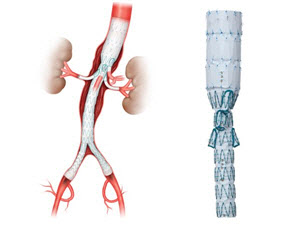 강남세브란스, 국내 최초 t-Branch 스텐트-그라프트 대동맥 시술 성공